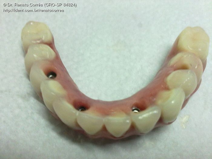 Protocolo Inferior com Carga Imediata, Caso clínico | iDent