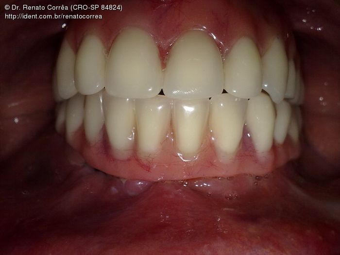Protocolo Inferior com Carga Imediata, Caso clínico | iDent