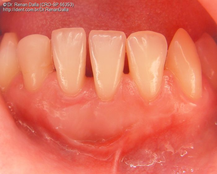 Frenectomia + Enxerto Gengival Livre para Recobrimento Radicular, Caso ...