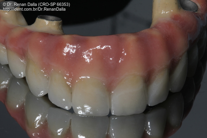 Protocolo Cerâmico Superior e Inferior, Caso clínico | iDent