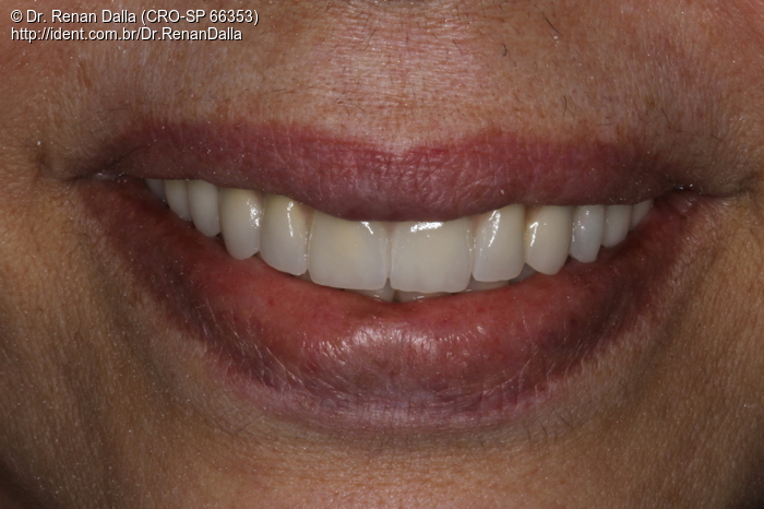 Protocolo Cerâmico Superior e Inferior, Caso clínico | iDent