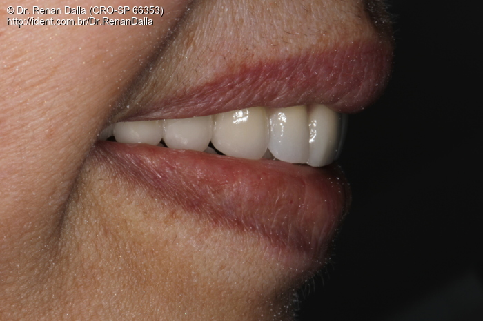Protocolo Cerâmico Superior e Inferior, Caso clínico | iDent