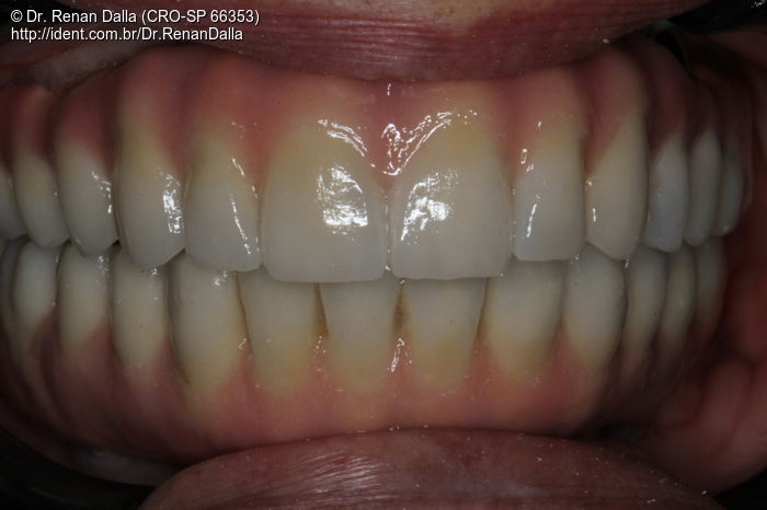 Protocolo Cerâmico Superior e Inferior, Caso clínico | iDent