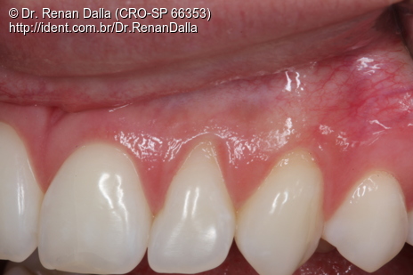 Recobrimentos Radiculares pela Técnica Vista Modificada, com Enxerto de ...