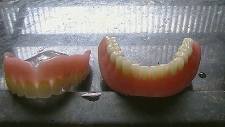 Prótese Total - Superior e Inferior, Caso clínico | iDent