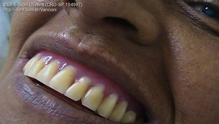 Prótese Total Superior e Inferior : Antes e Depois, Caso clínico | iDent