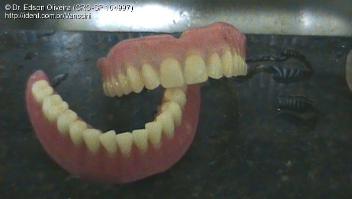 Prótese Total Superior e Inferior : Antes e Depois, Caso clínico | iDent