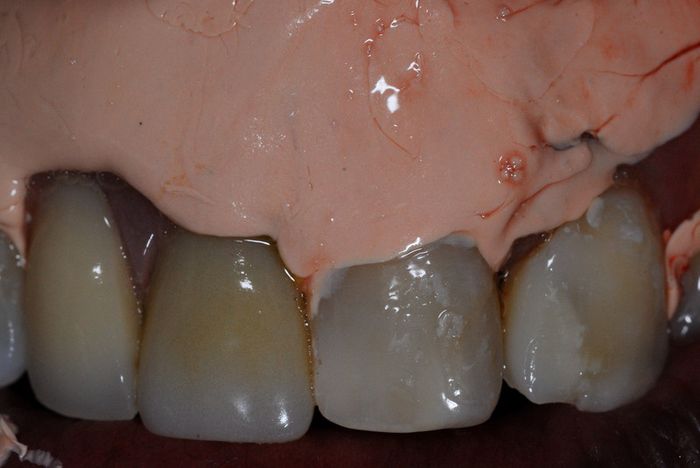 Frenectomia Labial Superior, Caso clínico | iDent