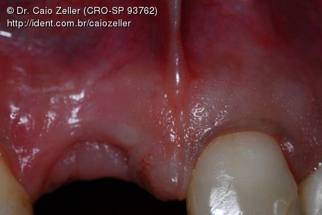 Frenectomia Labial Superior, Caso clínico | iDent