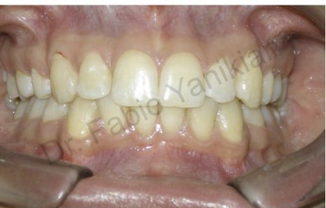 Apinhamento!, Caso clínico | iDent