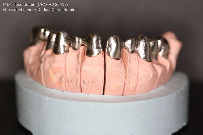 Prótese Fixa Metalo Cerâmica com Aumento da Dimensão Vertical de ...