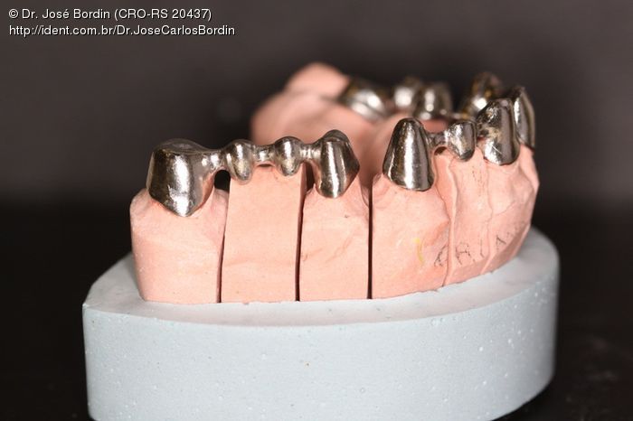 Prótese Fixa Metalo Cerâmica com Aumento da Dimensão Vertical de ...