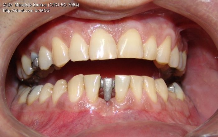 Prótese Fixa Adesiva Metalo-Cerâmica, Caso clínico | iDent