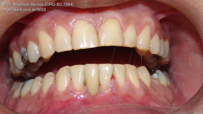 Prótese Fixa Adesiva Metalo-Cerâmica, Caso clínico | iDent