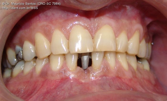 Prótese Fixa Adesiva Metalo-Cerâmica, Caso clínico | iDent