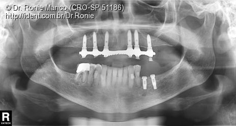 Protocolo Superior de Branemark., Caso clínico | iDent