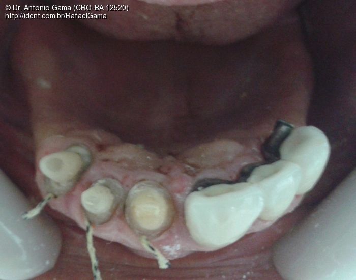 Prótese Fixa e Removível com Encaixe., Caso clínico | iDent