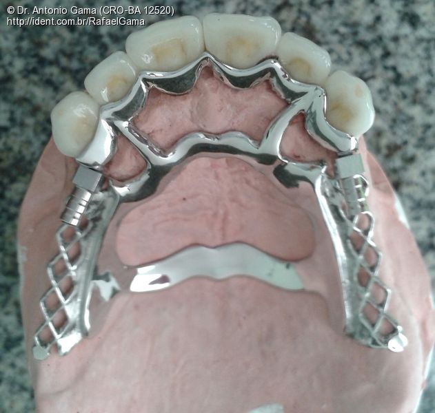 Prótese Fixa e Removível com Encaixe., Caso clínico | iDent