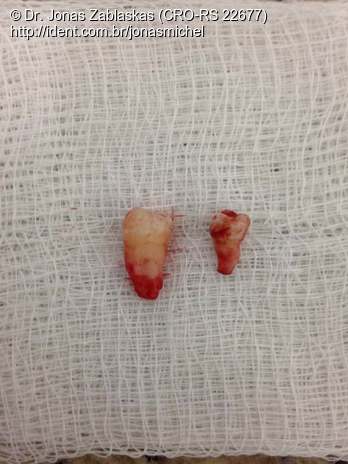 Exodontia de Siso Incluso/impactado e Dente Supranumerário, Caso ...