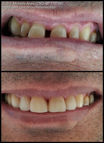 Facetas Diretas em Resina Composta, Caso clínico | iDent