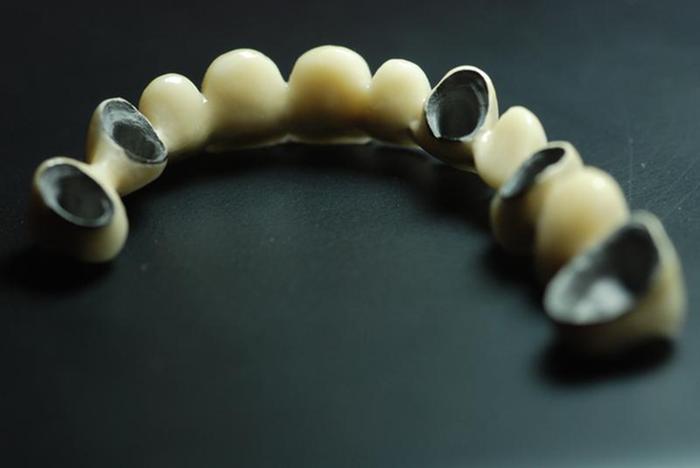 Prótese Fixa Metalocerâmica com 11 Elementos., Caso clínico | iDent