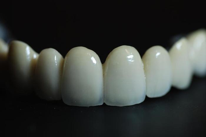 Prótese Fixa Metalocerâmica com 11 Elementos., Caso clínico | iDent