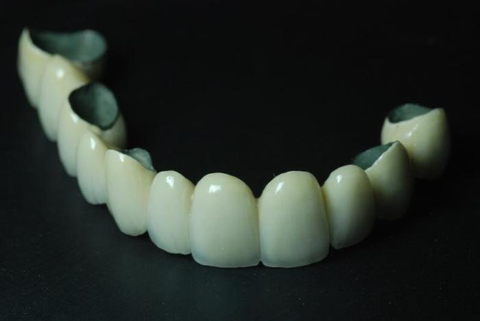 Prótese Fixa Metalocerâmica com 11 Elementos., Caso clínico | iDent