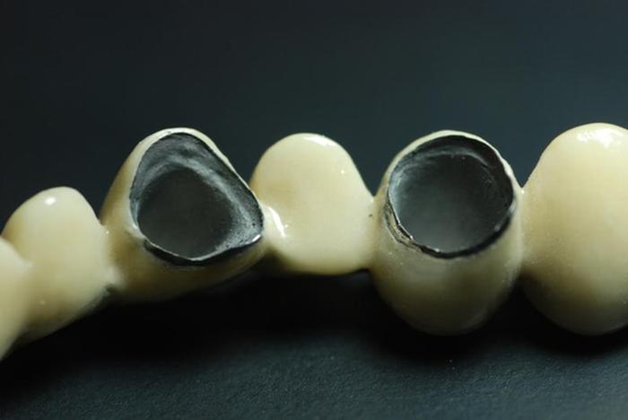 Prótese Fixa Metalocerâmica com 11 Elementos., Caso clínico | iDent