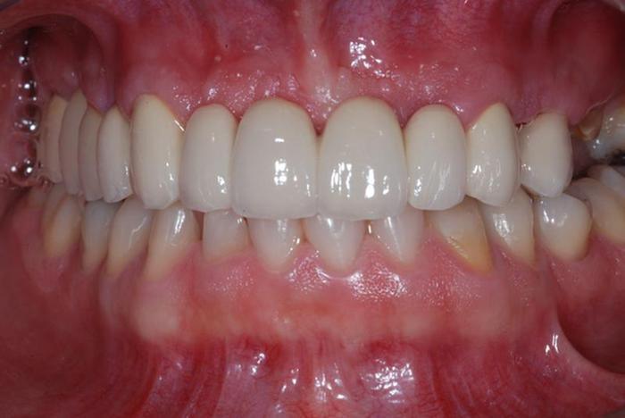 Prótese Fixa Metalocerâmica com 11 Elementos., Caso clínico | iDent