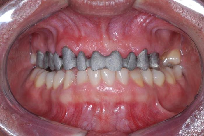 Prótese Fixa Metalocerâmica com 11 Elementos., Caso clínico | iDent