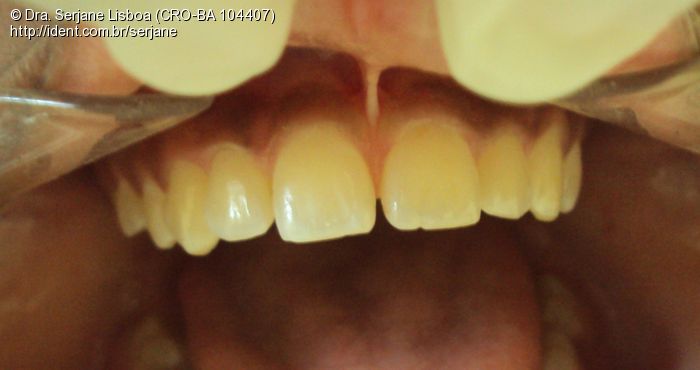 Frenectomia Labial Superior, Caso clínico | iDent