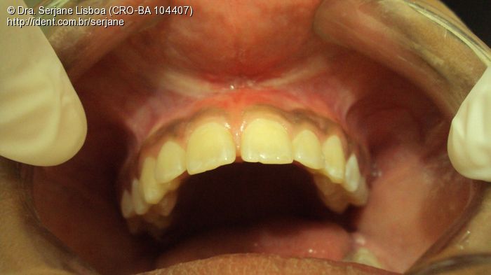 Frenectomia Labial Superior, Caso clínico | iDent