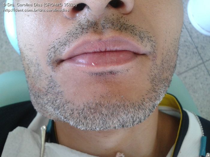 Drenagem de Abscesso Extra Oral em Centro de Saúde, Caso clínico | iDent