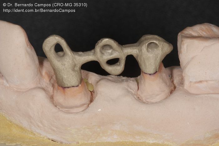 Ponte Fixa 3 Elementos, Caso clínico | iDent