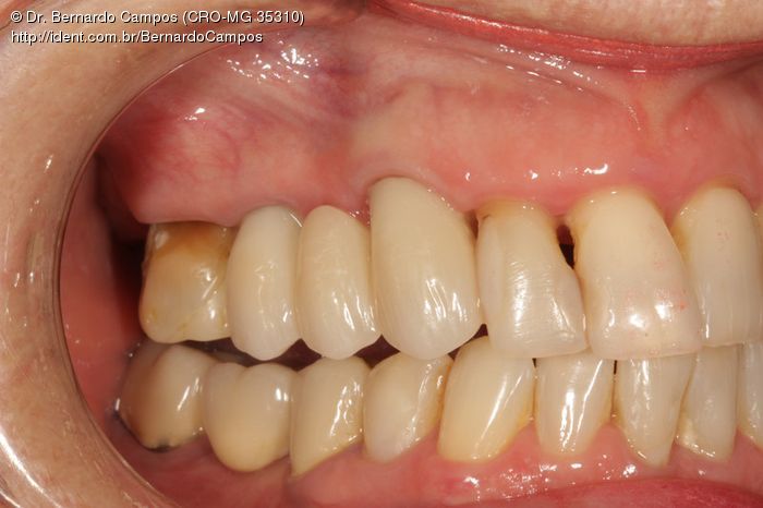 Ponte Fixa 3 Elementos, Caso clínico | iDent