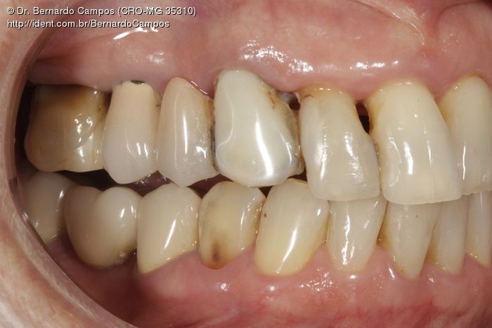 Ponte Fixa 3 Elementos, Caso clínico | iDent