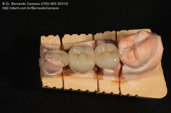 Ponte Fixa 3 Elementos, Caso clínico | iDent