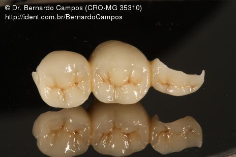Ponte Fixa 3 Elementos, Caso clínico | iDent