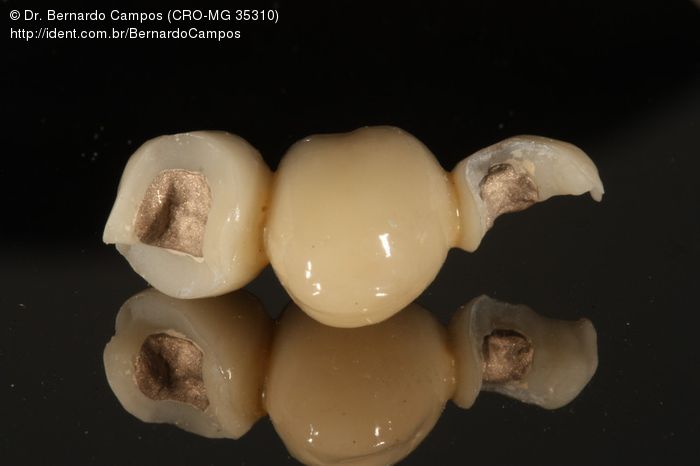 Ponte Fixa 3 Elementos, Caso clínico | iDent