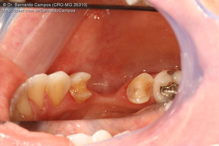 Ponte Fixa 3 Elementos, Caso clínico | iDent