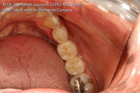 Ponte Fixa 3 Elementos, Caso clínico | iDent
