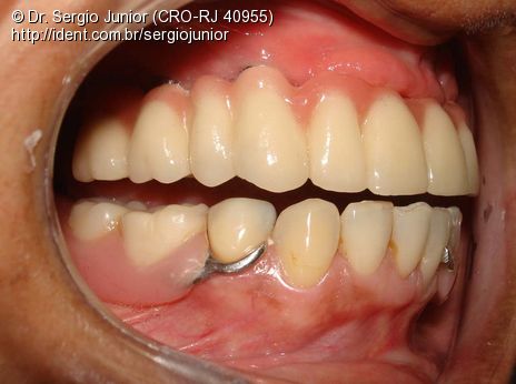 Prótese Total Fixa Sobre Implante, Caso clínico | iDent