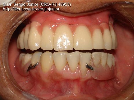 Prótese Total Fixa Sobre Implante, Caso clínico | iDent