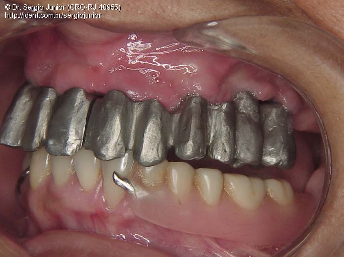 Prótese Total Fixa Sobre Implante, Caso clínico | iDent