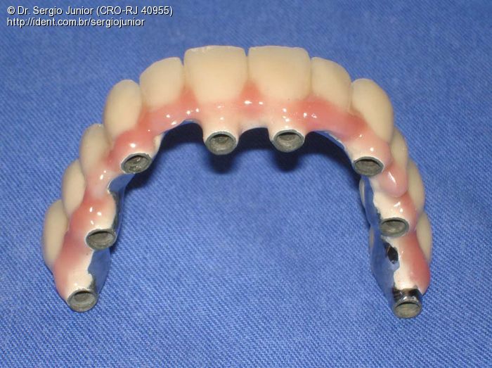 Prótese Total Fixa Sobre Implante, Caso clínico | iDent