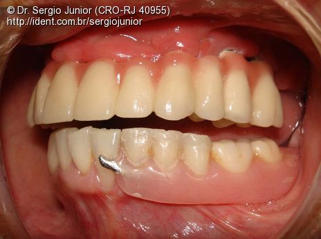 Prótese Total Fixa Sobre Implante, Caso clínico | iDent