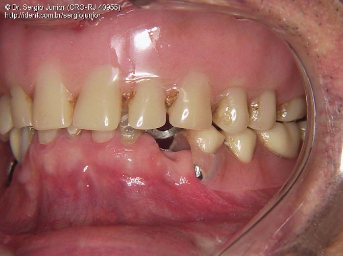 Prótese Protocolo Inferior e Prótese Total Removível Superior, Caso ...