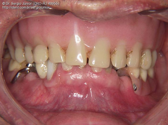 Prótese Protocolo Inferior e Prótese Total Removível Superior, Caso ...