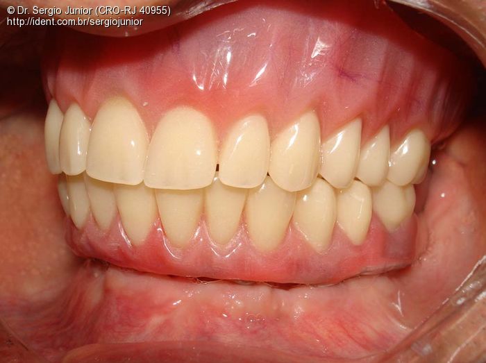 Prótese Protocolo Inferior e Prótese Total Removível Superior, Caso ...