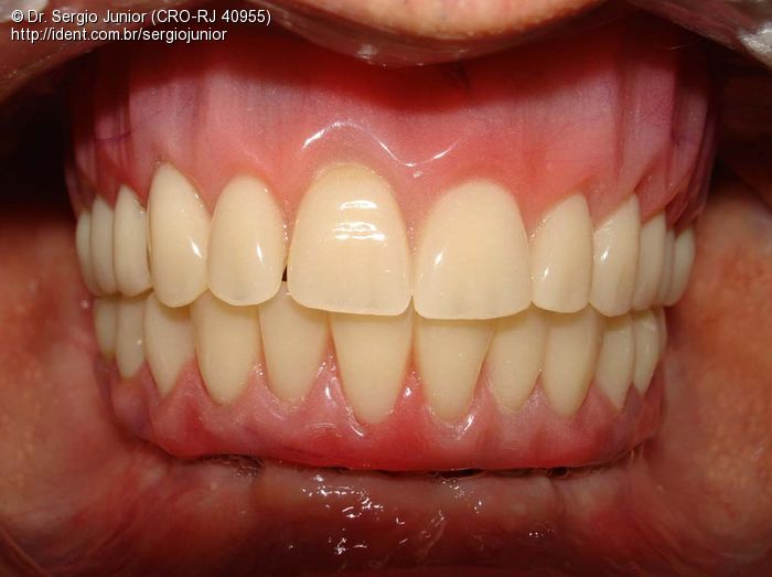 Prótese Protocolo Inferior e Prótese Total Removível Superior, Caso ...